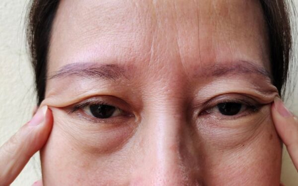 Is Eye Bag Removal Permanent? - Kowayo Aesthetic Clinic Singapore
