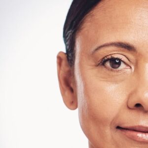 Crow's Feet Treatment Singapore - Kowayo Aesthetic Clinic